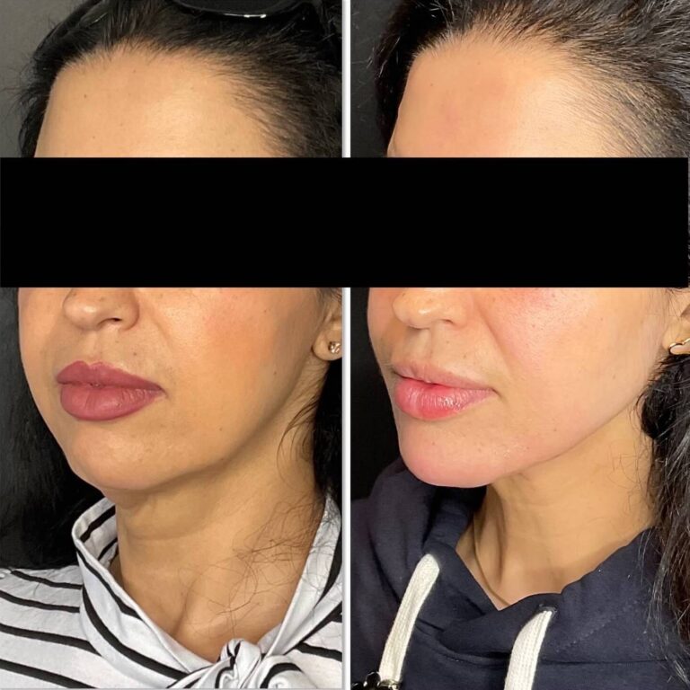 Melasma Treatments - Dr Liesel Holler