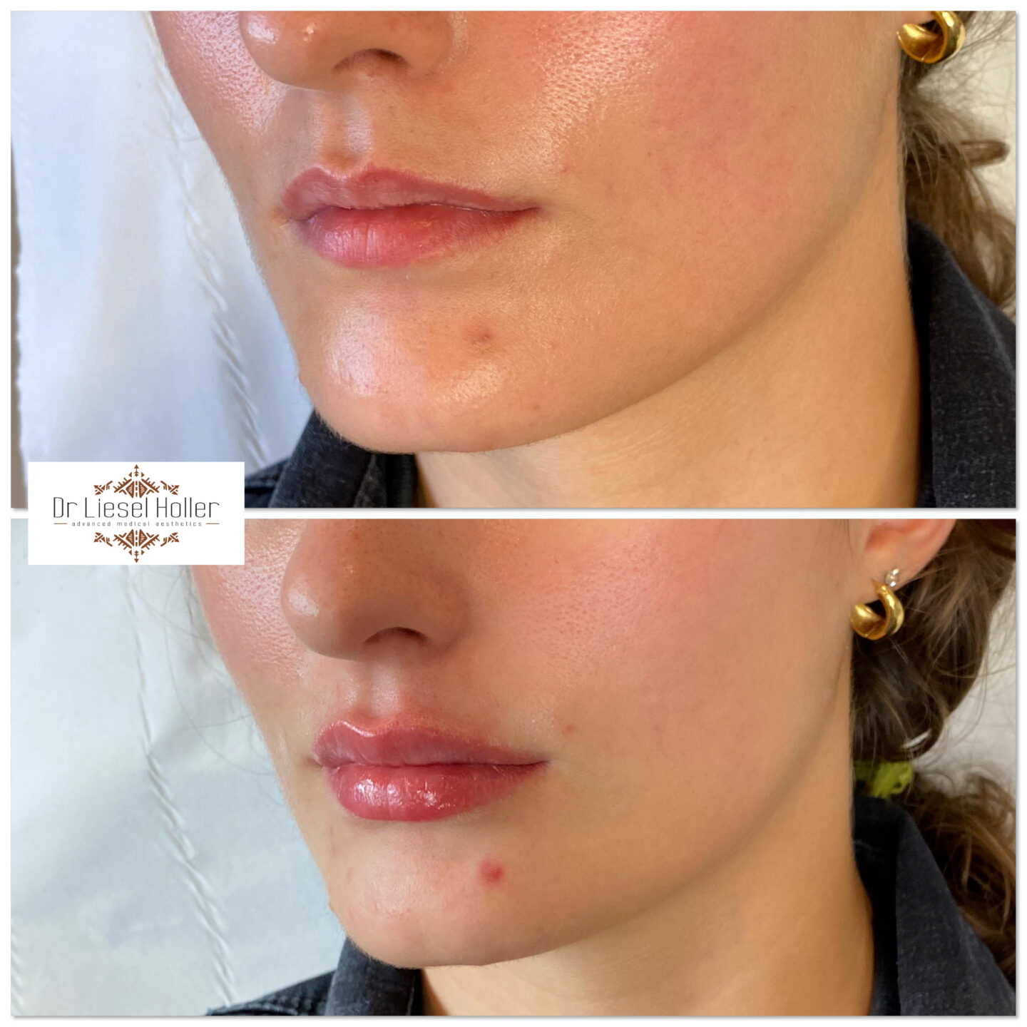 Lip Fillers in Bromley & Harley Street | Dr Liesel Holler