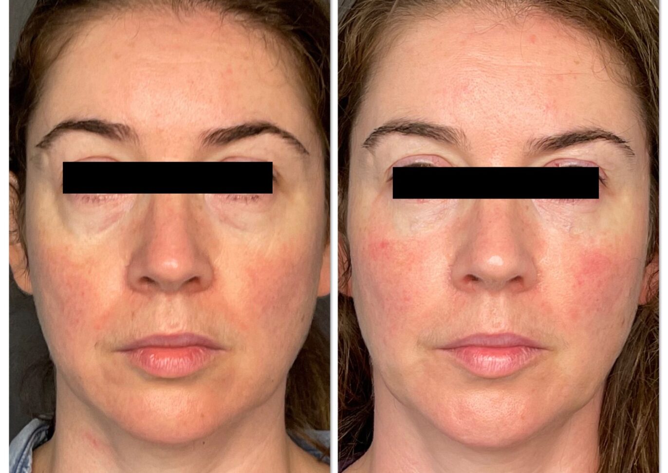 How to get rid of dark circles? - Dr Liesel Holler