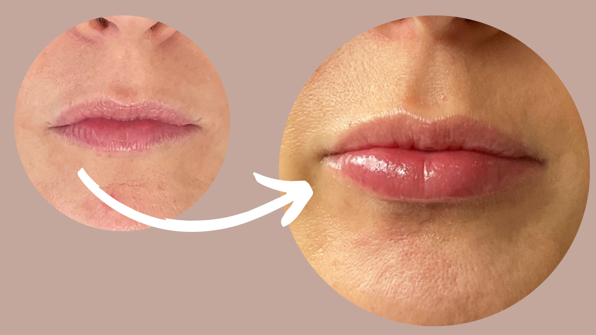 Natural Looking Lip Fillers for Thin Lips - Dr Liesel Holler